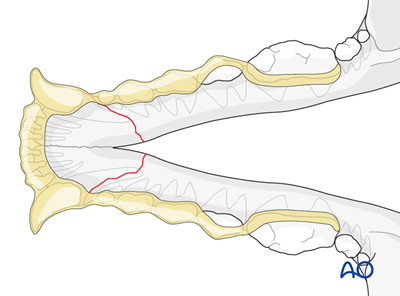 Wire reinforced intraoral splinting for Mandible, Rostral: Bilateral ...