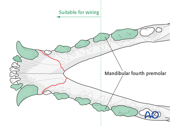 Wire reinforced intraoral splinting for Mandible, Rostral: Bilateral ...