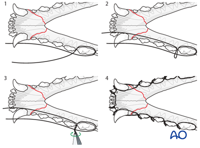 Wire reinforced intraoral splinting for Mandible, Rostral: Bilateral ...