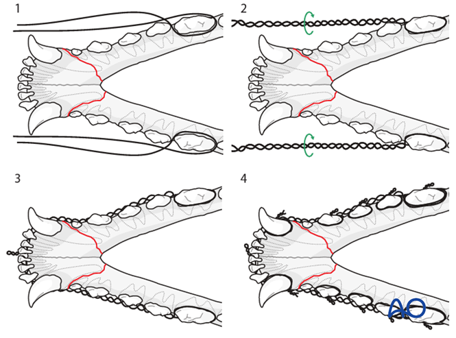 Wire reinforced intraoral splinting for Mandible, Rostral: Bilateral ...