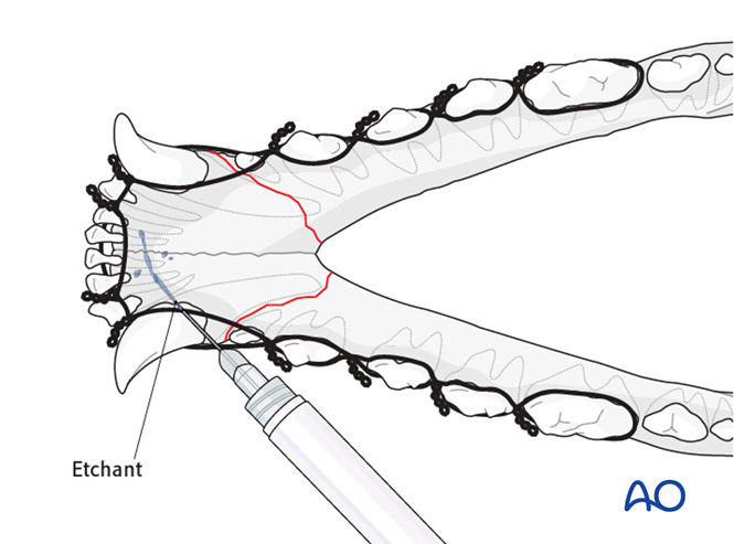 Wire reinforced intraoral splinting for Mandible, Rostral: Bilateral ...
