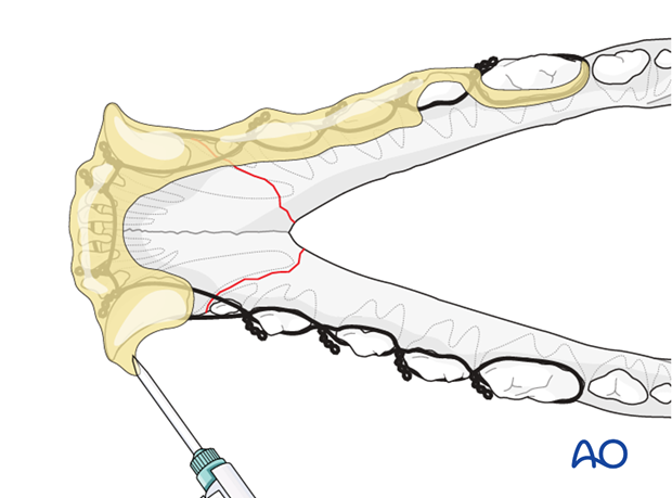 Wire reinforced intraoral splinting for Mandible, Rostral: Bilateral ...