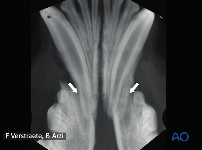 Wire reinforced intraoral splinting for Mandible, Rostral: Unilateral ...