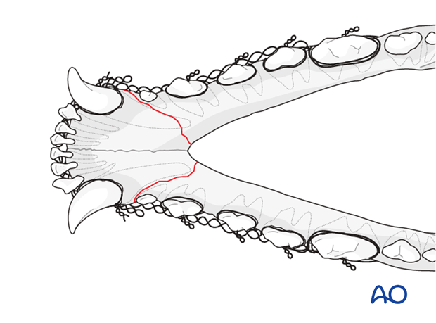 Wire reinforced intraoral splinting for Mandible, Rostral: Bilateral ...