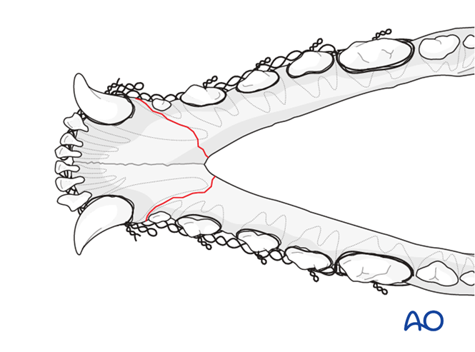 Wire reinforced intraoral splinting for Mandible, Rostral: Bilateral ...
