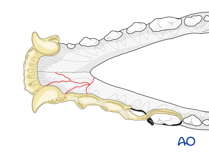 Wire reinforced intraoral splinting for Mandible, Rostral: Unilateral ...
