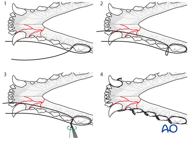 Interdental Wiring For Mandibular Fracture Repair