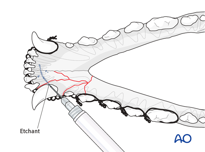 Wire reinforced intraoral splinting for Mandible, Rostral: Unilateral ...