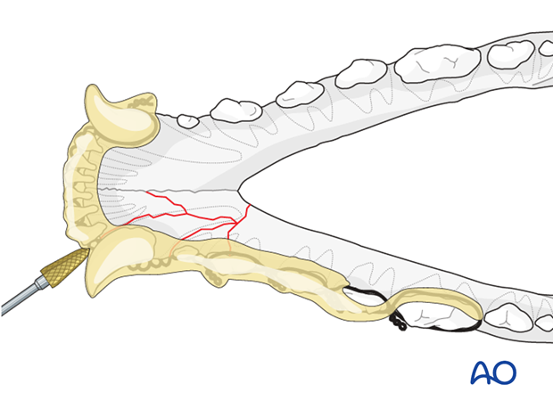 Interdental Wiring For Mandibular Fracture Repair