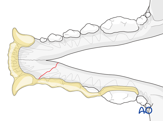 Wire reinforced intraoral splinting for Mandible, Rostral: Unilateral ...