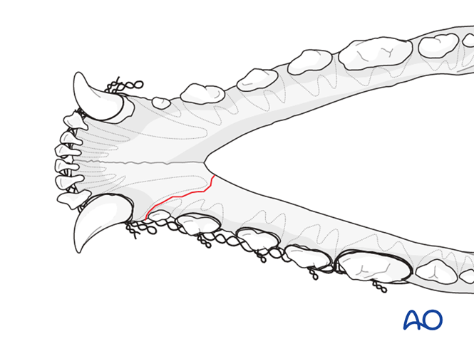 Wire reinforced intraoral splinting for Mandible, Rostral: Unilateral ...