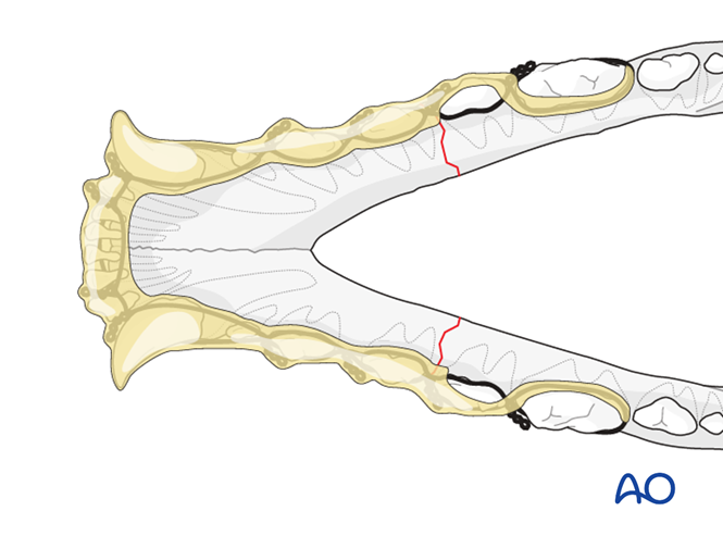 Wire reinforced intraoral splinting for Mandible, Body: Bilateral simple