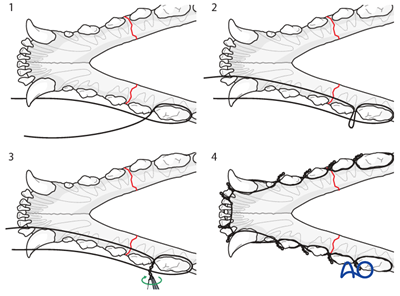 Wire reinforced intraoral splinting for Mandible, Body: Bilateral simple