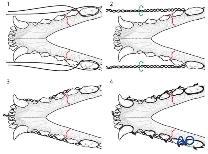 Wire reinforced intraoral splinting for Mandible, Body: Bilateral simple