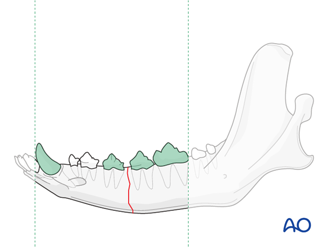 Wire reinforced intraoral splinting for Mandible, Body: Unilateral ...