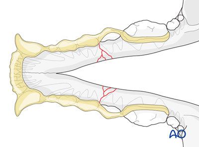 Wire reinforced intraoral splinting for Mandible, Body: Bilateral ...