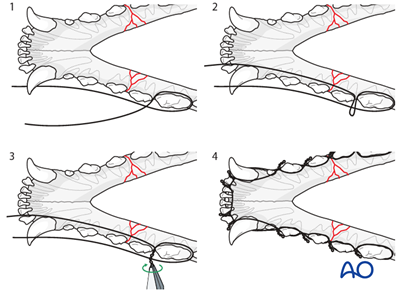 Wire reinforced intraoral splinting for Mandible, Body: Bilateral ...