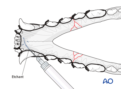 Wire reinforced intraoral splinting for Mandible, Body: Bilateral ...