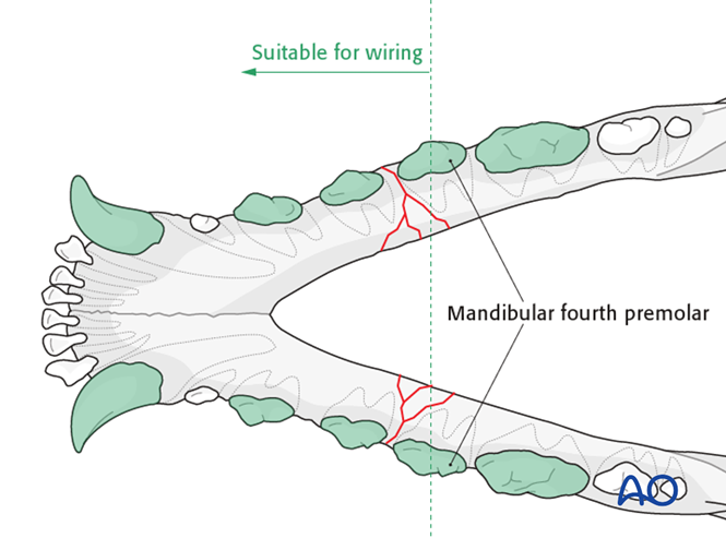 Wire reinforced intraoral splinting for Mandible, Body: Bilateral ...