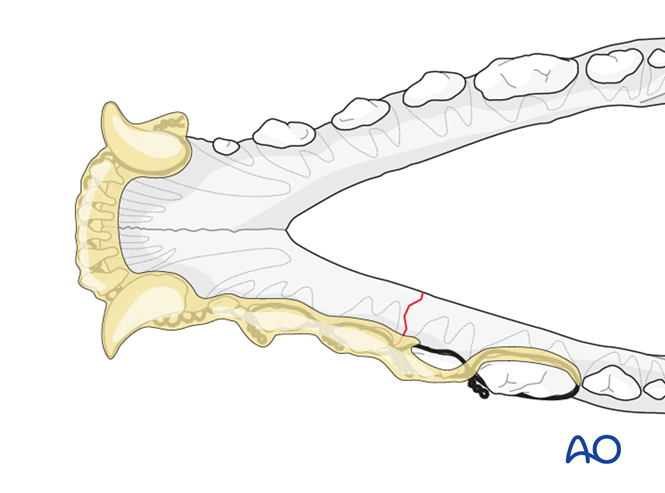 Wire reinforced intraoral splinting for Mandible, Body: Unilateral ...