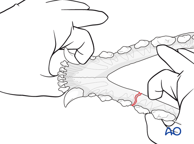 Wire reinforced intraoral splinting for Mandible, Body: Unilateral ...