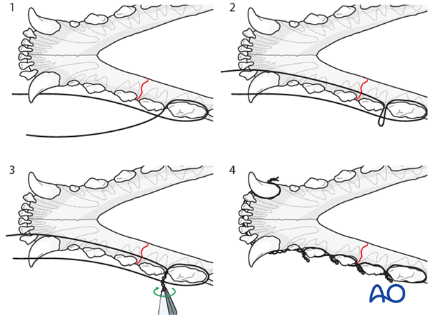 Wire reinforced intraoral splinting for Mandible, Body: Unilateral ...
