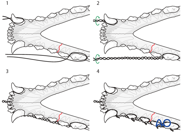 Wire reinforced intraoral splinting for Mandible, Body: Unilateral ...