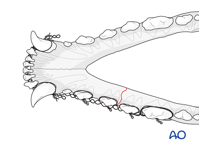 Wire reinforced intraoral splinting for Mandible, Body: Unilateral ...
