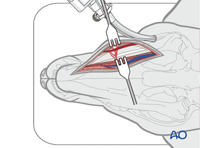 External skeletal fixator for Mandible, Body: Unilateral comminuted ...