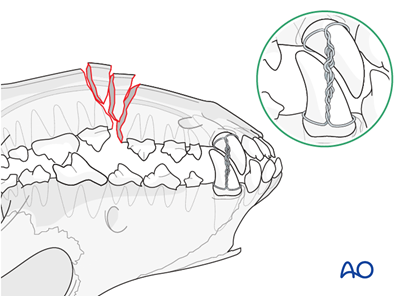 External skeletal fixator for Mandible, Body: Unilateral comminuted ...
