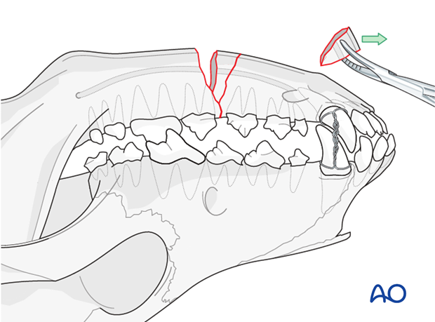 Plate fixation for Mandible, Body: Bilateral comminuted