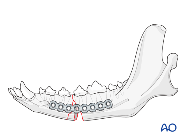 Plate Fixation For Mandible Body Bilateral Comminuted