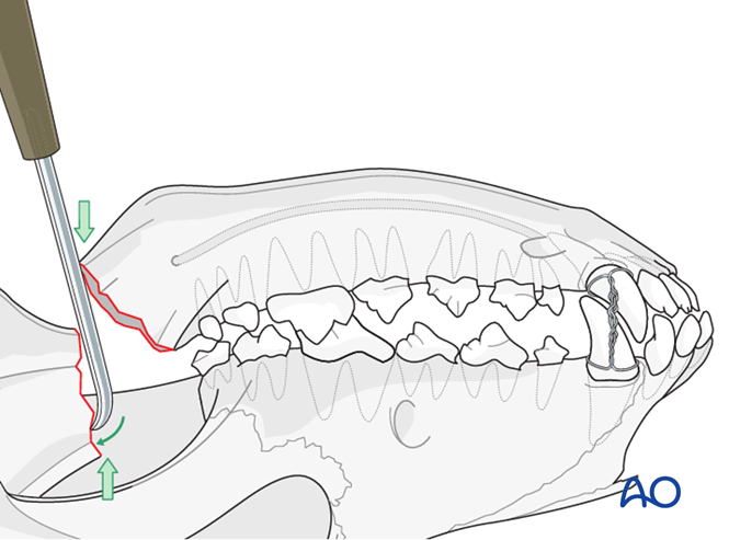 Plate fixation for Mandible, Ramus fractures