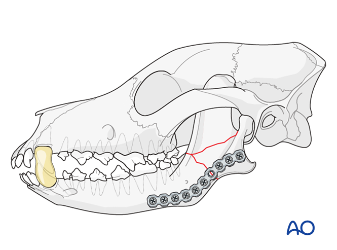 Plate fixation for Mandible, Ramus fractures