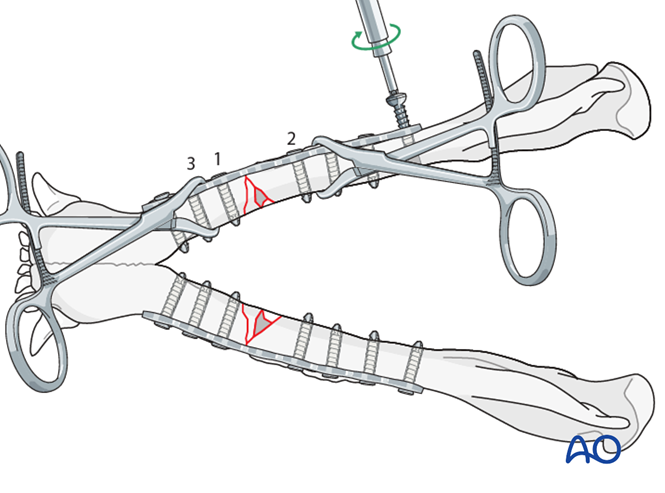 Plate fixation for Mandible, Body: Bilateral comminuted