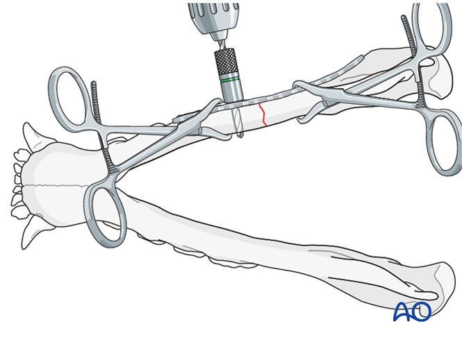 Plate fixation for Mandible, Caudal: Unilateral simple fractures