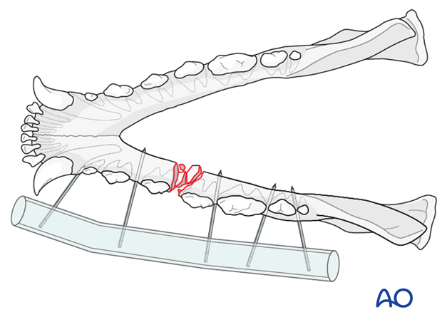 External skeletal fixator for Mandible, Body: Unilateral comminuted ...