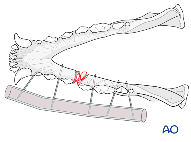 External skeletal fixator for Mandible, Body: Unilateral comminuted ...