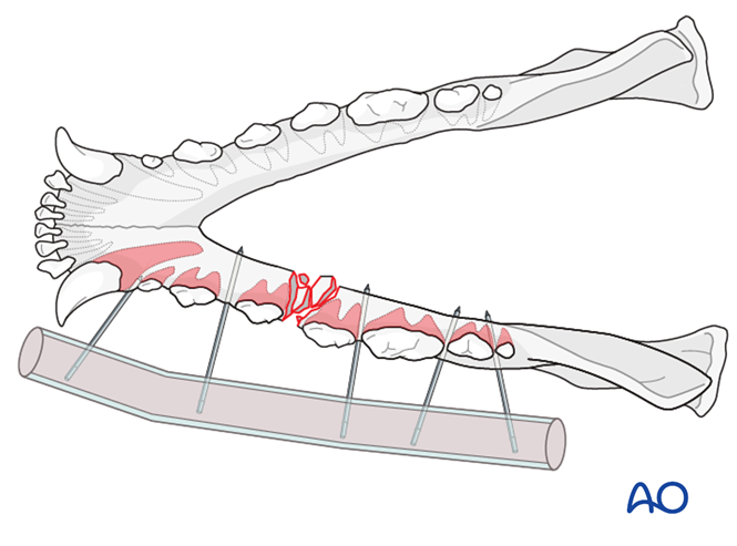 External skeletal fixator for Mandible, Body: Unilateral comminuted ...