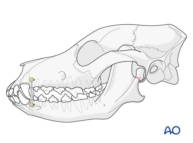 Intermaxillary fixation (IMF) screw and elastic chain for Mandible ...