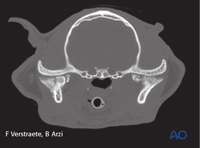 Intermaxillary fixation (IMF) screw and elastic chain for Mandible ...
