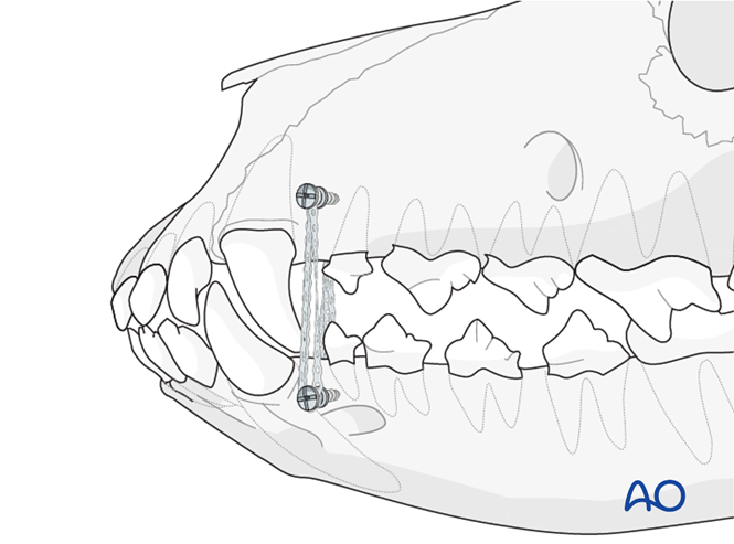 Intermaxillary fixation (IMF) screw and elastic chain for Mandible ...