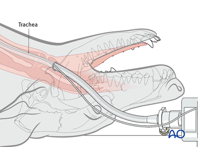 External skeletal fixator for Mandible, Body: Unilateral comminuted ...