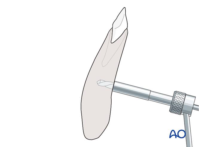 Intermaxillary fixation (IMF) screw and elastic chain for Mandible ...