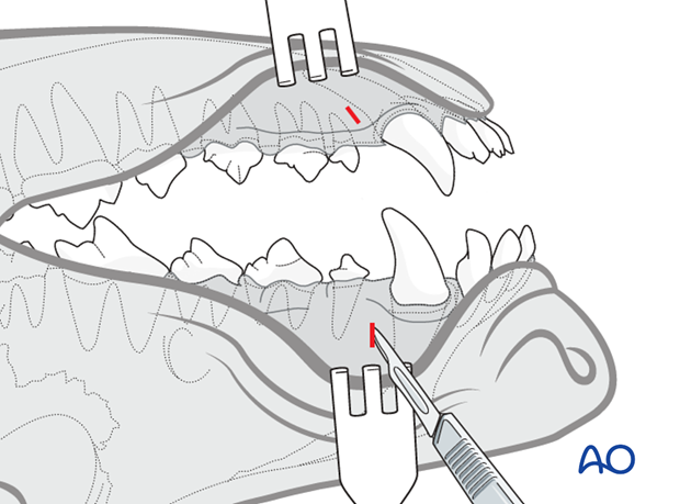 Intermaxillary fixation (IMF) screw and elastic chain for Mandible ...