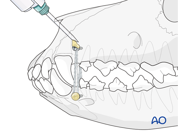 Intermaxillary fixation (IMF) screw and elastic chain for Mandible ...