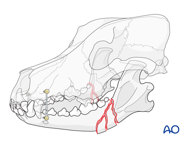 Intermaxillary fixation (IMF) screw and elastic chain for Mandible ...