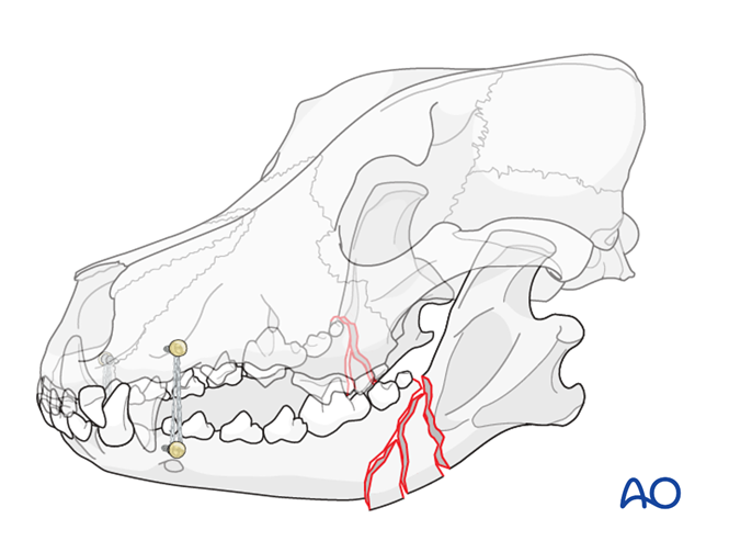 Intermaxillary fixation (IMF) screw and elastic chain for Mandible ...