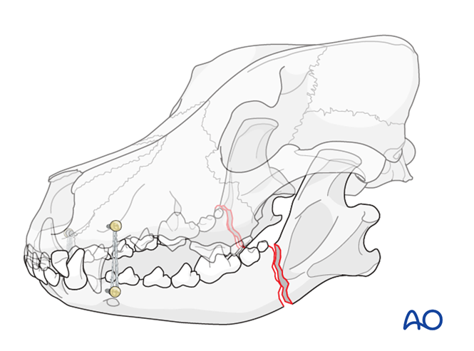 Intermaxillary fixation (IMF) screw and elastic chain for Mandible ...