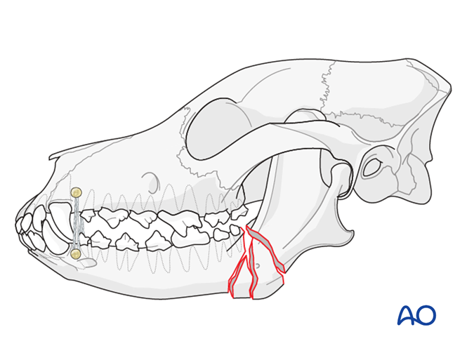 Intermaxillary fixation (IMF) screw and elastic chain for Mandible ...